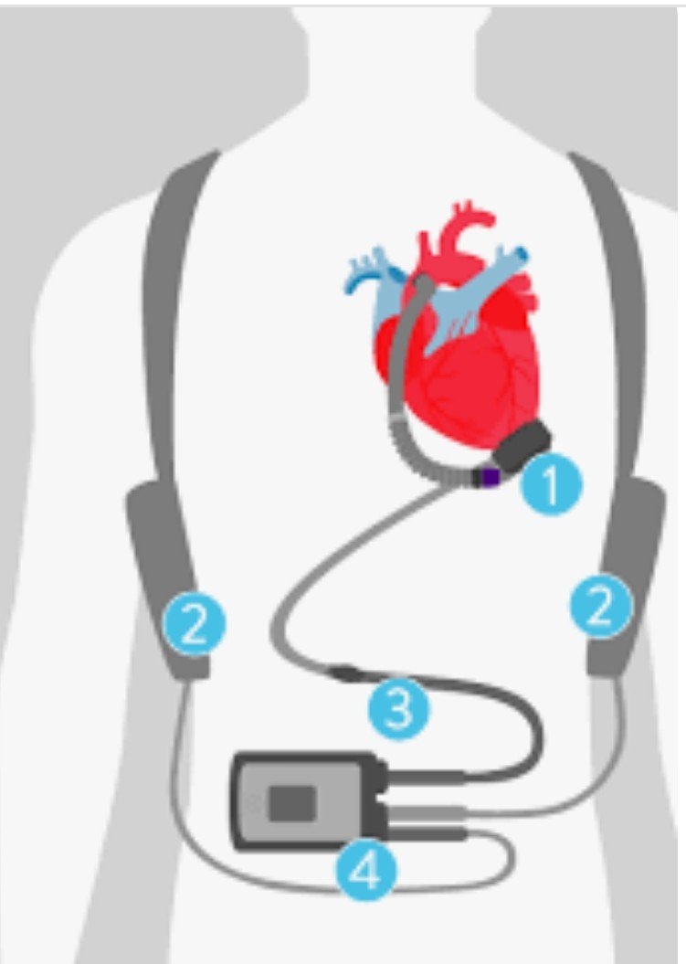 Army Hospital (R&R) performs India’s first-ever Left Ventricular Assist ...